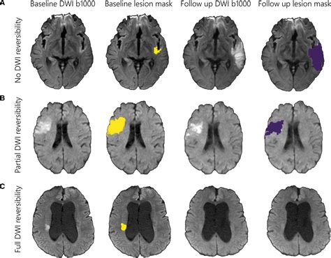 Reversibility Of Diffusion Weighted Imaging Lesions In Patients With Ischemic Stroke In The Wake