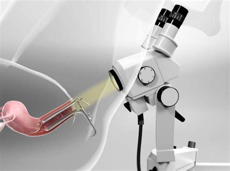 Video Colposcopy Guided Cervical Biopsy Healthclips Online