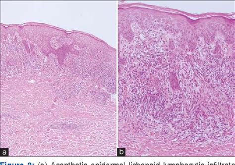 Figure 1 From Lichen Aureus Induced By An Insect Bite Semantic Scholar
