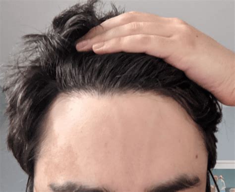 Am I Thinning Balding R Malehairadvice