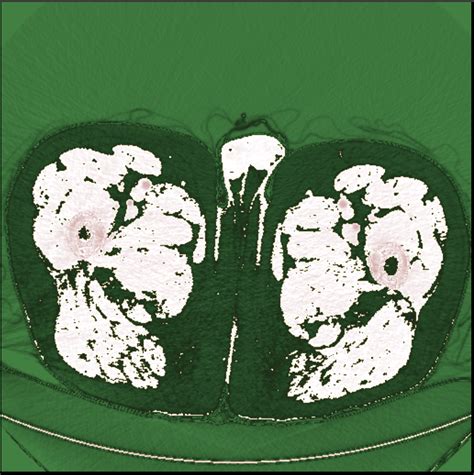 Javascript Pixel Mapping For Rendering DICOM Monochrome2 Stack Overflow