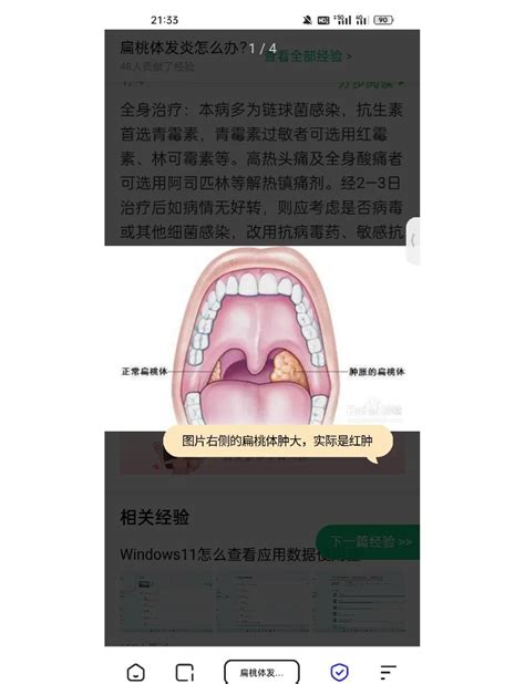 扁桃体发炎症状与处理