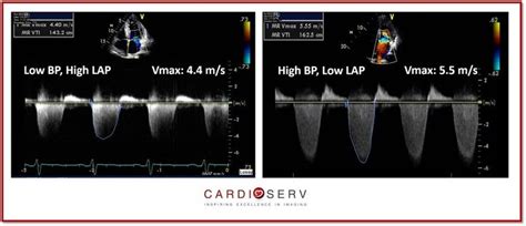 Velocity Mitral Regurgitation Cw Jet Velocity Alby Andaka
