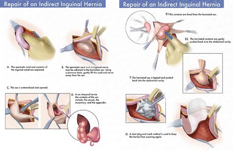 Indirect Inguinal Hernia Repair