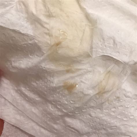 Is This Normal Discharge For Being 6 Weeks Pregnant Im Scared This