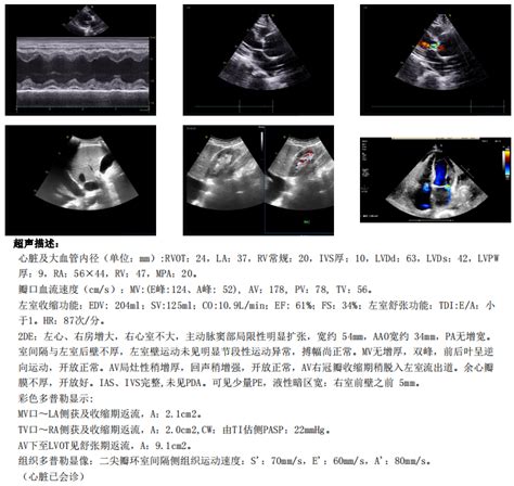 再创全球首例：梅州市人民医院完成经颈动脉tavr（纯反流巨大瓦式窦瘤大瓣环横位心）tevarpyras 一站三式”手术 严道医声网