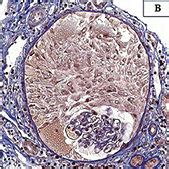Widespread Segmental Necrosis And Partial Or Circumferential Download Scientific Diagram