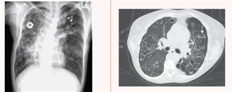 Bronchiectasis And Atelectasis Flashcards Quizlet