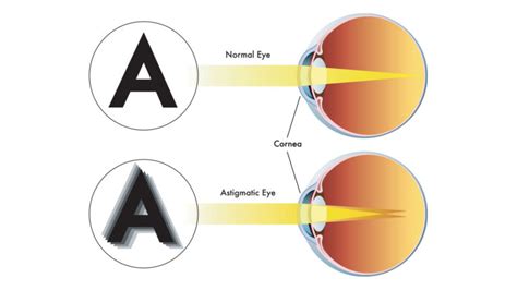 Conquer Astigmatism Laser Eye Surgery In London