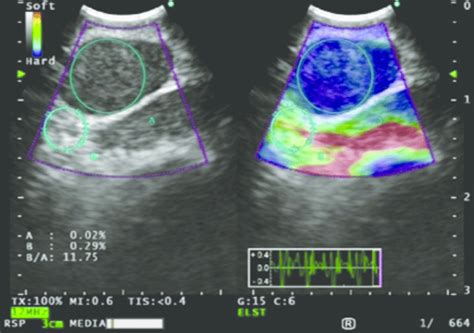 Elastography In A Malignant Lymph Node Download Scientific Diagram