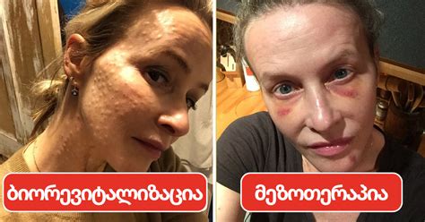 მოდური კოსმეტოლოგიური პროცედურები და მათი შედეგები რეალური გამოცდილება