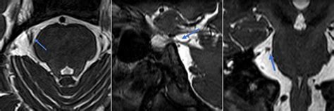 Adding Some Separation From The Superior Cerebellar Artery Relieves Trigeminal Neuralgia