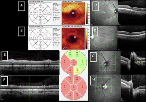 Methanol Toxicity Characteristics Ophthalmological Sequelae And