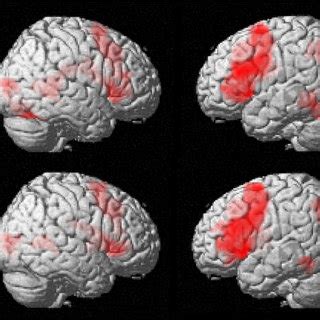 Illustrates Task Related FMRI Results Surface Renderings Of Bilateral Download Scientific