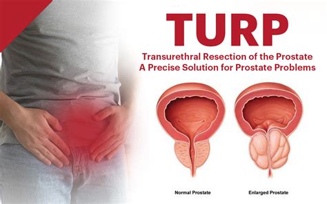 Transurethral Resection Of The Prostate Turp A Precise Solution For