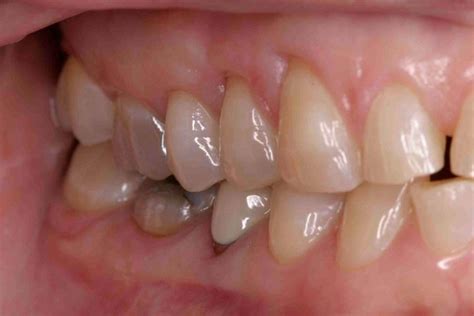 Decreasing Root Sensitivity During Treatment Lee Ann Brady Dmd