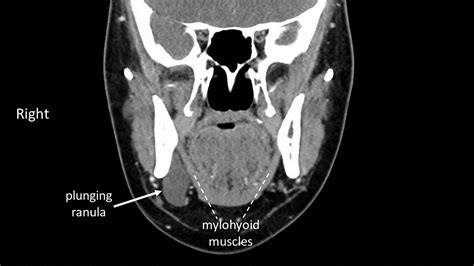 Submandibular Gland Anatomy The Uncinate Process Of The Deep Lobe