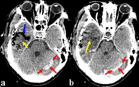 Brain Ct Scan In Axial Plane And Parenchymal Window Before A And