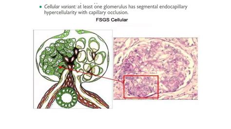 Focal Segmental Glomerulosclerosis Fsgs Kdigo 2021 Guidelines Dr Gawad Pdf