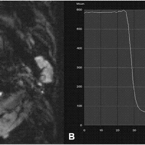53 Year Old Woman With Adenocarcinoma A Dynamic Susceptibility Download Scientific Diagram