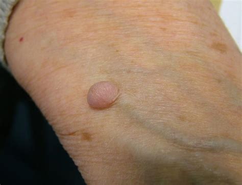 Neurofibromatosis 1 Genesis Comprendre La Neurofibromatose 1 Nf1