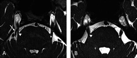 Sex Differences In Trigeminal Neuralgia A Focus On Radiological And Clinical Characteristics Pmc