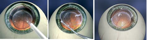 Lasik Vs Icl Dr Vincent Lee