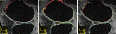 Bone And Cartilage Segmentation A Segmentation Achieved Using The Download Scientific