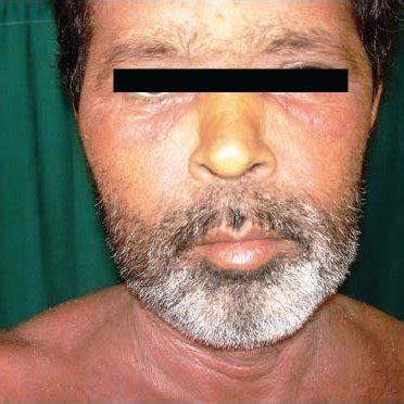 Psoriatic Erythroderma Download Scientific Diagram