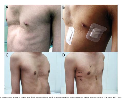 Figure 1 From Modified Nuss Procedure In The Treatment Of Recurrent Pectus Excavatum After Open