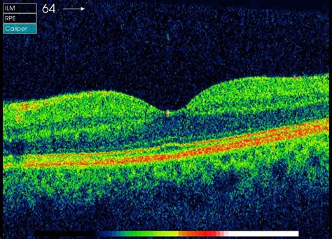 Glaucoma Care Vision North Boston Comprehensive Eye Care