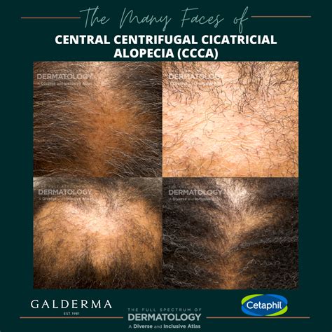 Central Centrifugal Cicatricial Alopecia Ccca Archives Next Steps In Dermatology Central Centrifugal Cicatricial Alopecia Ccca Archives Next Steps In Dermatology