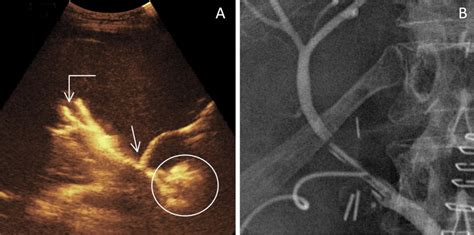 Normal T Tube Ceus Cholangiography Findings In A 54 Year Old Man Who