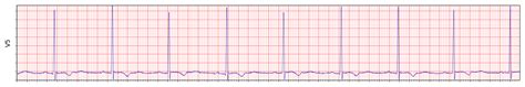 Interpretable Ecg Classification With 1d Vision Transformer Yoni Gottesman