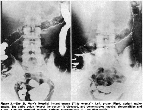 Differential Diagnosis Of Crohns Disease And Ulcerative Colitis At