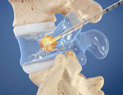 Intracept Procedure Texas Spine And Scoliosis