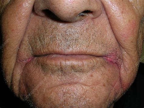 Angular Cheilitis Stock Image C056 4953 Science Photo Library