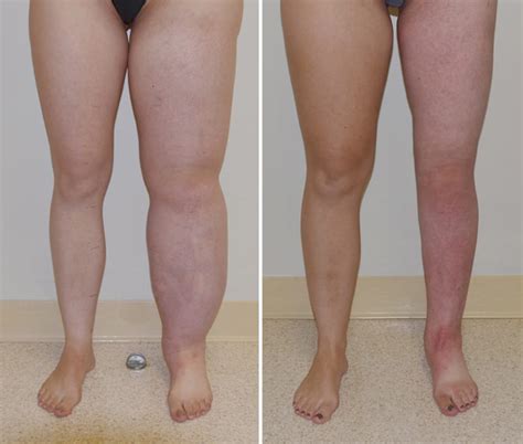 Leg Edema Vs Lymphedema At Howard Vasquez Blog