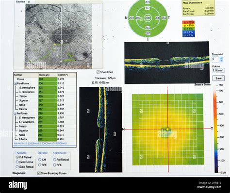 Oct Of The Eye Reveals Faint Epimacular Membrane And Full Thickness