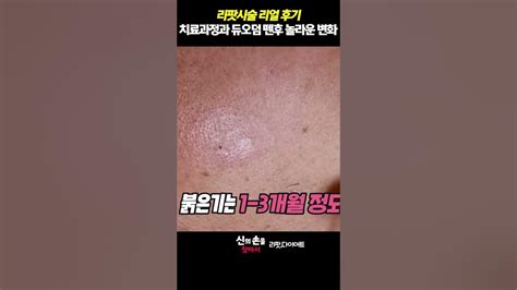 리팟시술 리얼후기 치료과정과 듀오덤 뗀후 놀라운 변화 검버섯없애기 흑자제거 리팟레이저전후 Youtube