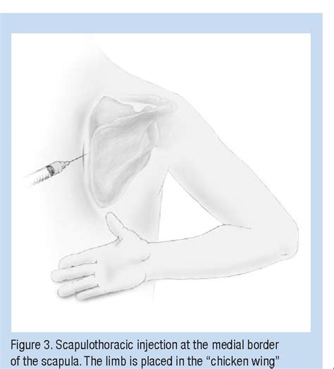 Scapular Bursitis Injection At Joshua Allingham Blog
