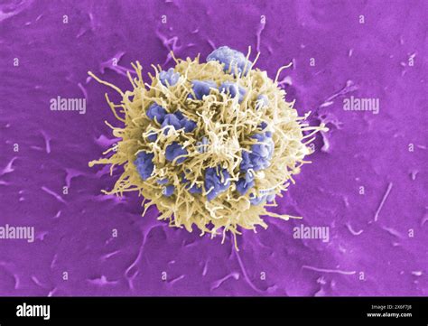 Cervical Cancer Cell Coloured Scanning Electron Micrograph Sem The Cervix Also Called The