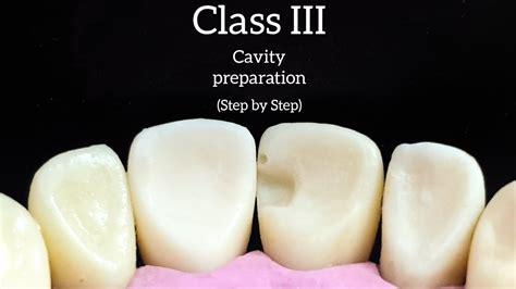Class Iii Cavity Preparation Step By Step With Explanation Upper Incisor خطوة بخطوة مع الشرح