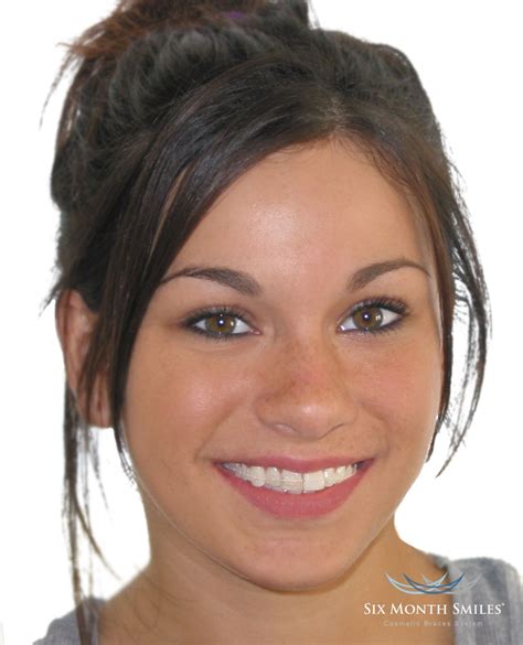 6 Month Braces Artofit