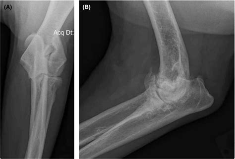 Radiographs Of The Left Cubital Joint A Craniocaudal And B Lateral