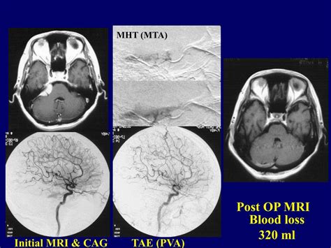 Ppt Preoperative Embolization Of Brain Tumor With Dural Branch Of