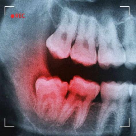 사랑니구멍 발치 부위 수술 당일 피 출혈 지혈 문제 압박지혈 네이버 블로그