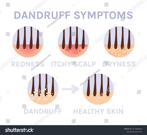 Dryness Scalp 26개가 넘는 로열티 프리 라이선스 대상 스톡 일러스트 및 그림 Shutterstock