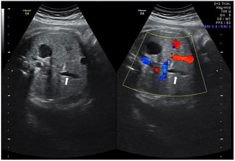 Pregnancy Outcomes Of Non Visualization Of The Fetal Gallbladder From A Chinese Tertiary Single