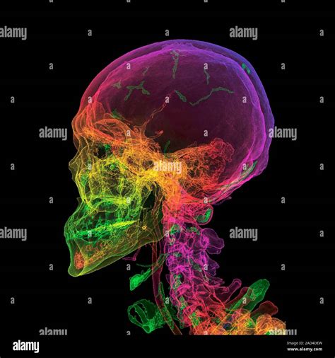 Normal Skull Coloured 3d Computed Tomography Ct Scan Of A Normal